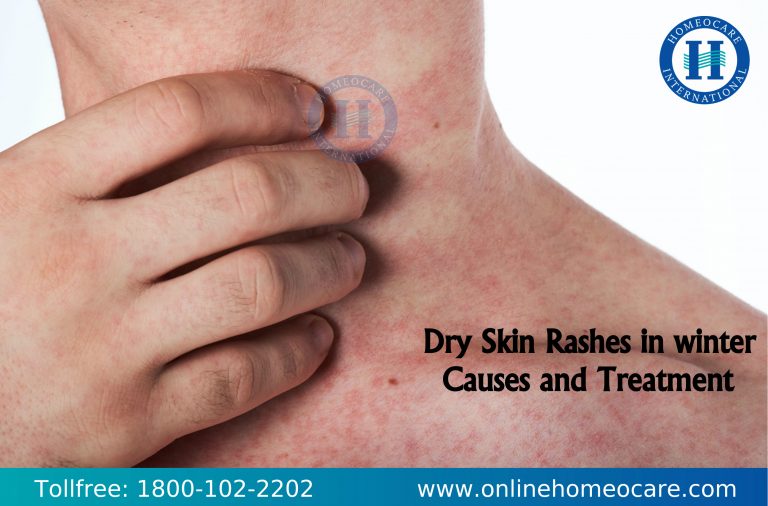 Dry Skin Rashes in Winter – Causes and Treatment – Online Homeocare